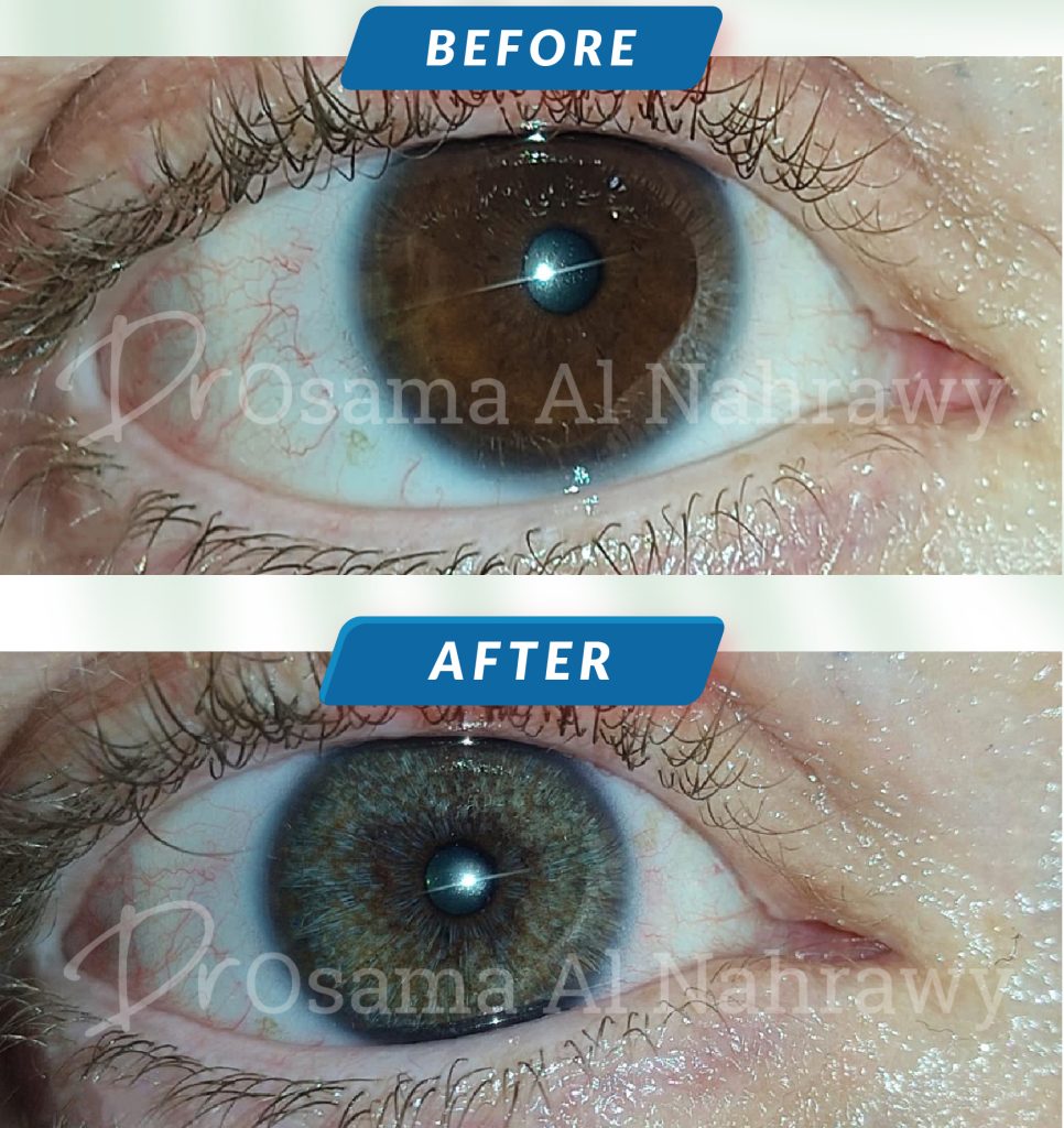 Iris Melanin Depigmentation - Dr.OsamaAlNahrawy